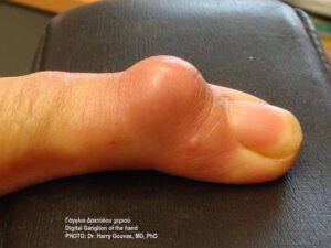 Don't Bash the Bible Bump! (aka the Ganglion Cyst)